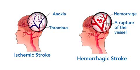 Stroke Program | Hunterdon
